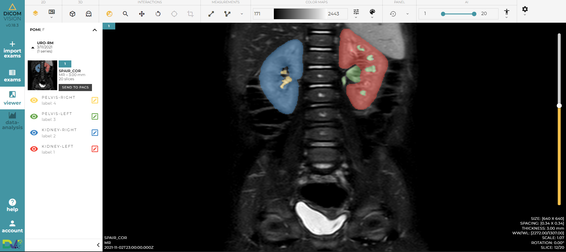 DICOM Vision at the service of clinical research: a case study with the ...